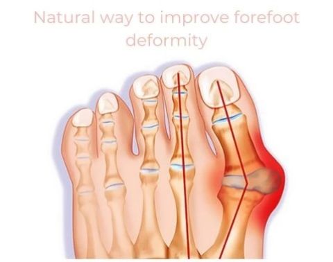 Ortopedski korektor za prste na nogah (1 par: levo + desno) FIXEDFEET ...